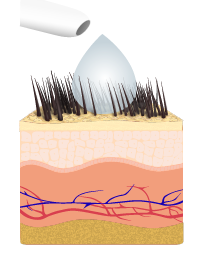 Zorbium™ (buprenorphine transdermal solution)